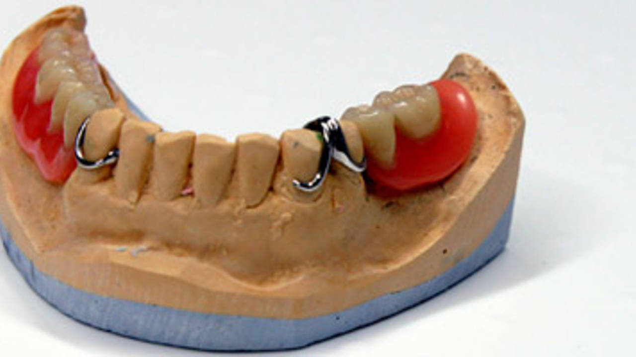 Klammerprothese - Praxis Dr. Gebhard